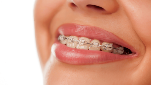LightForce is Here – 3D Printed Braces For Personalized Treatment ...
